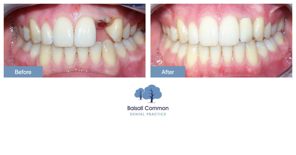 Implant and bonded retainer - Balsall Common Dental