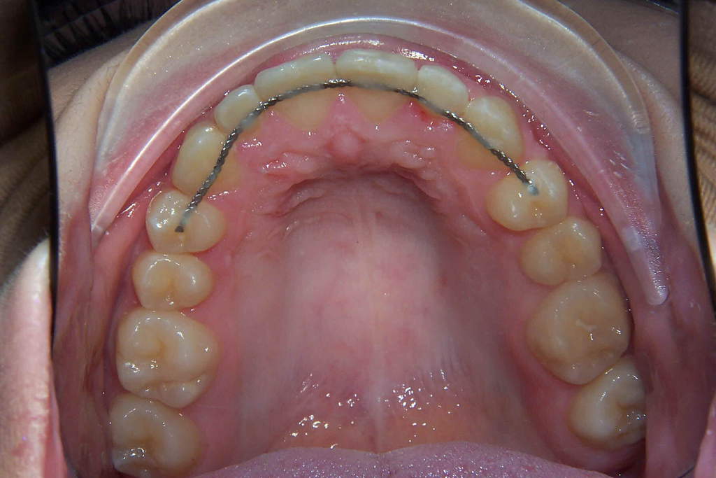 Removable and fixed orthodontics - Balsall Common Dental