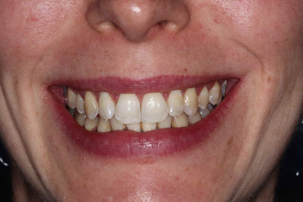 Aligners and Bonded Retainer | Balsall Common Dental Practice