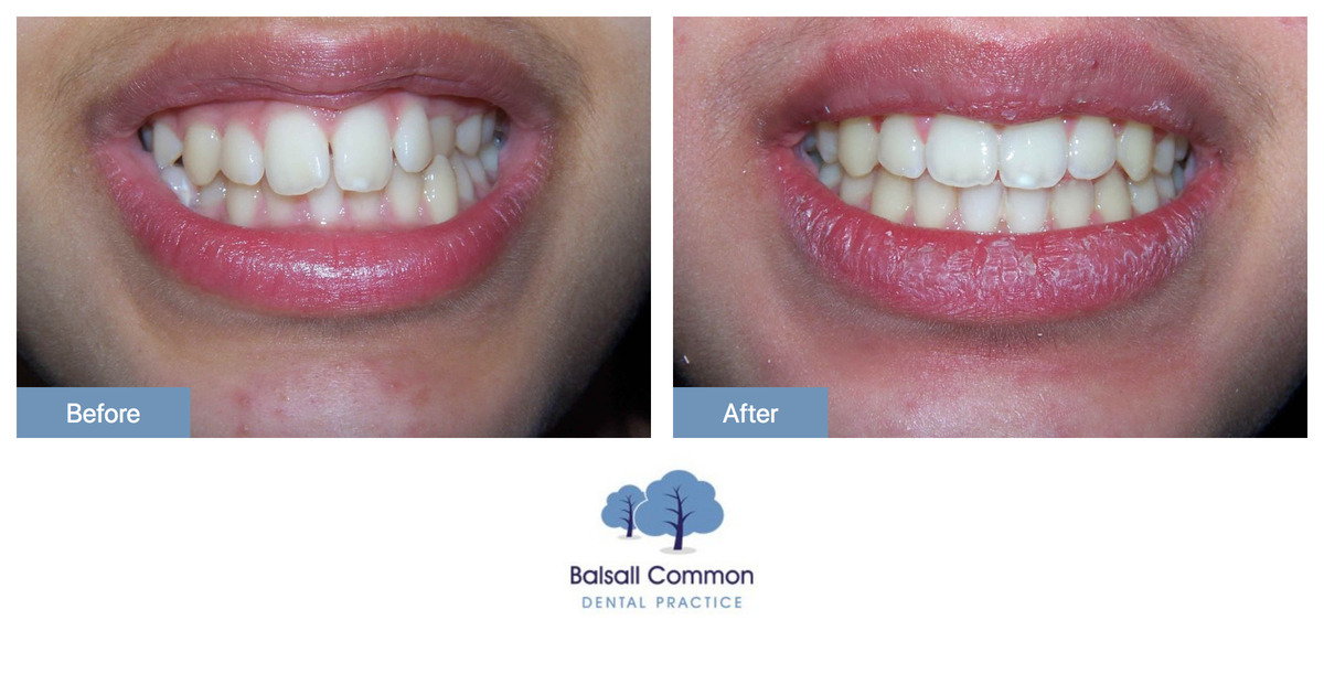 Removable and fixed braces to straighten teeth - Balsall Common Dental