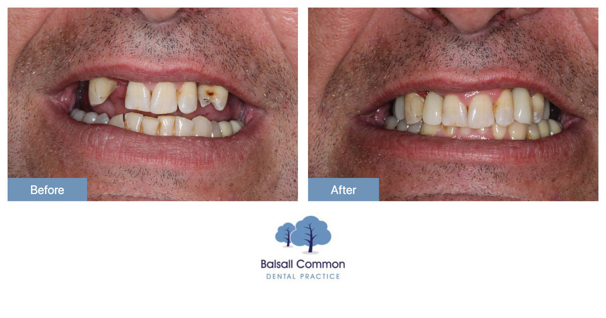 Tooth colored fillings and dental implants - Balsall Common Dental
