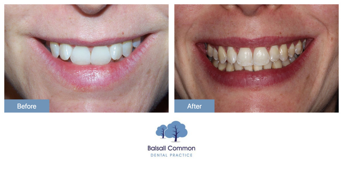 Clear aligners and fixed braces - Balsall Common Dental